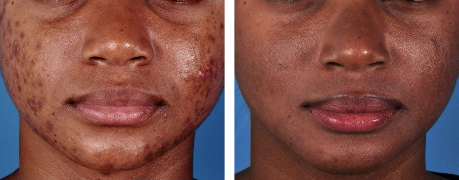 ZO Skin Health Acne control pads - em clinic Esthetic Medicine