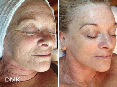 DMK Enzyme Therapy - em clinic Esthetic Medicine